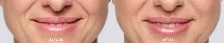 Lip Fillers | Sculpt Med Spa