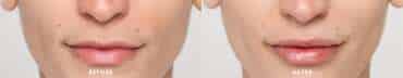 Lip Fillers Los Angeles CA | Enhance + Plump Your Lips